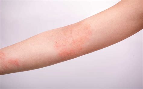 How To Manage Contact Dermatitis Rash Complete Guide
