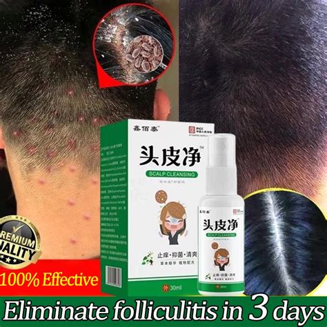 Seborrheic Dermatitis Spray Folliculitis Spray Anti Dandruff Spray