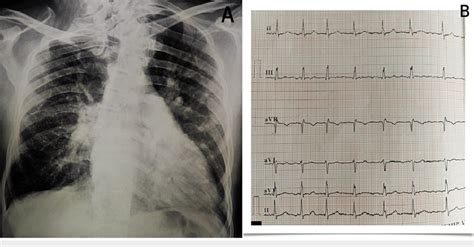 A A Chest X Ray Showing The Left Pulmonary Artery Is Prominent There