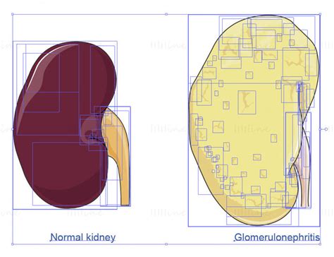 Glomerulonephritis Vector