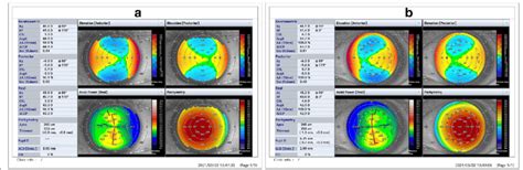 Swept Source Oct Ss Oct Corneal Map Mode Results 16 Radial B Scans
