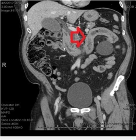 Ct Abdomen Pelvis Showing Thickening Of The Duodenum And Proximal Small