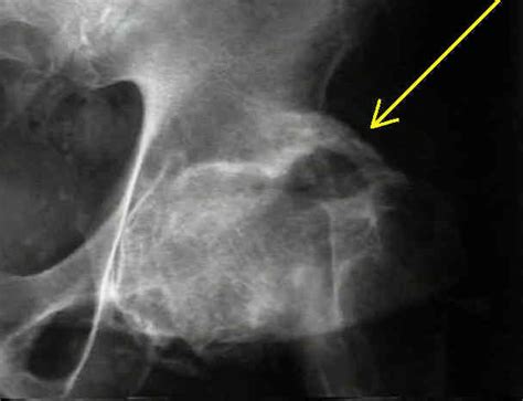 Renal Osteodystrophy Quick Facts About Renal Osteodystrophy