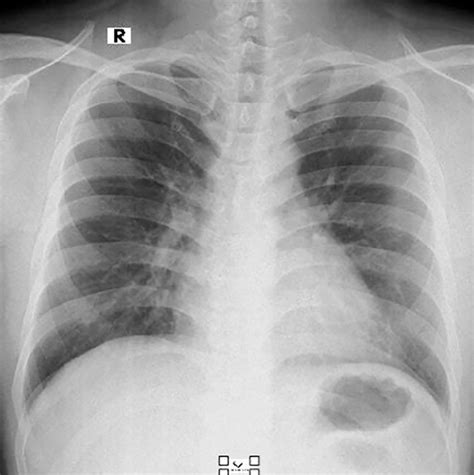 Chest X Ray Patient Shows No Abnormality In The Lung Parenchyma Download Scientific Diagram