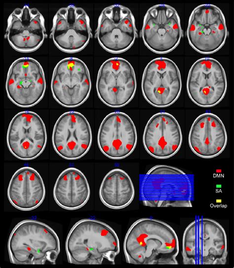 Overlap Between The Conceptual Self Awareness Network And The Dmn