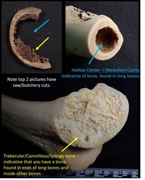 Using Osteoid Osteoid Bone Identification