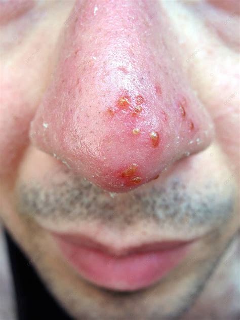 Sore In Nose