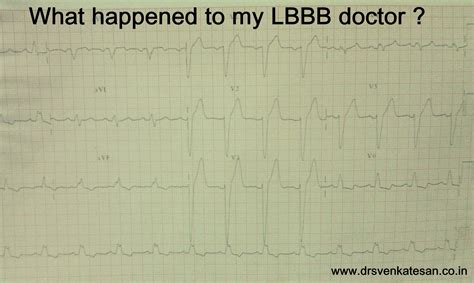 Lbbb Dr S Venkatesan Md