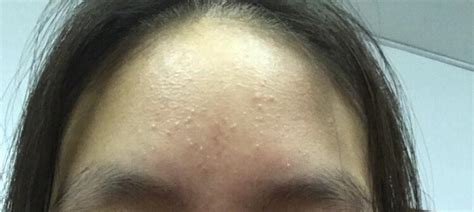 Help Pimples On Forehead Wont Go Away Racne