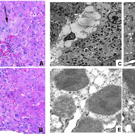 Histological And Ultrastructural Analysis Of Liver Tissue From Patient