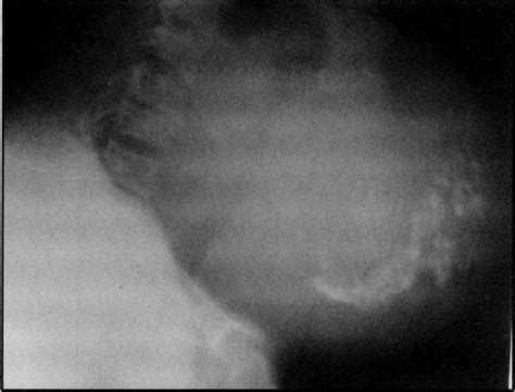 Neck Radiograph Showing Goiter With Retrosternal Extension Tracheal Download Scientific