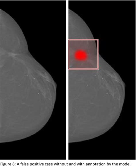 Figure From A Two Stage Mammography Classification Model Using