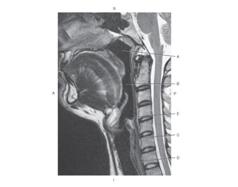 Sagittal T2 Weighted Mri Of Lumbar Vertebra — Printable Worksheet