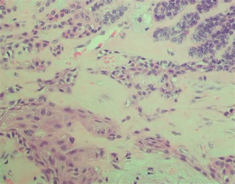 Histological Findings Of The Tumor Stained With Hematoxylin And Eosin