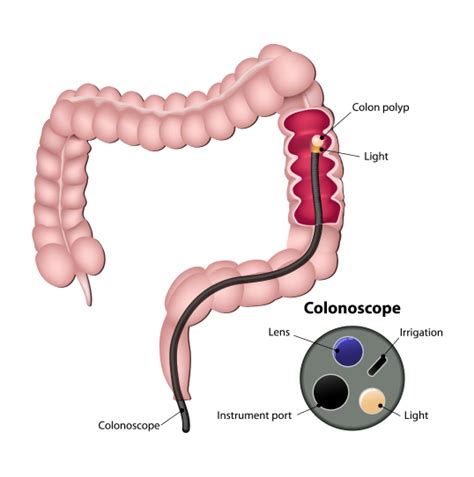 Colonoscopy Screening Singapore Thesurgeons Colonoscopy Clinic