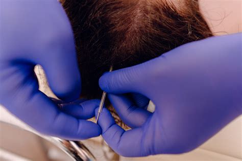 중국 전통 의학 치료 침술 가리키기에 대한 스톡 사진 및 기타 이미지 가리키기 개념 건강관리와 의술 Istock