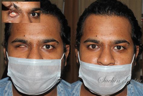 Scleral Shell In Delhi India Art Eyes India