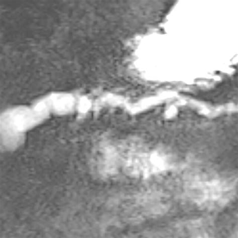 Magnetic Resonance Cholangiopancreatography Of Main Duct Intraductal