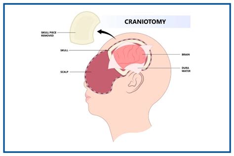 Craniotomy Indications Lifestyle Changes Recovery