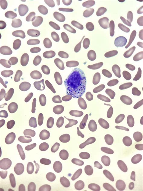 Basophil Myelocyte Rmedlabprofessionals