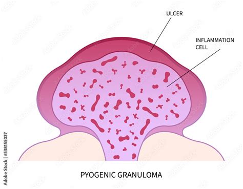 Pyogenic Granuloma Skin Tumor Disease Stock Vector Adobe Stock