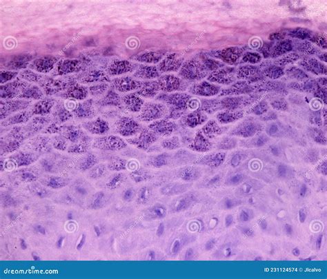 Epidermis De Verrugas Plantares Foto De Archivo Imagen De Epitelio