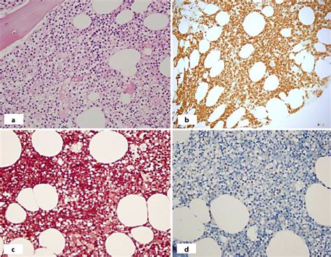 The Bone Marrow Is Markedly Hypercellular Due To Interstitial And