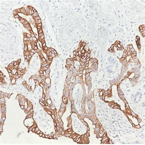 Cancer Diagnostic Antibody And Proteinpathological Diagnostic Reagent Cancer Diagnostic Antibody And Proteinpathological Diagnostic Reagent