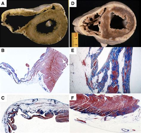 Arrhythmogenic Cardiomyopathy Circulation Research
