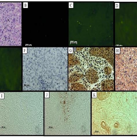 Well Differentiated Squamous Cell Carcinoma Verrucous Carcinoma A