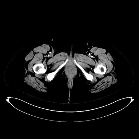 Pelvis Chondrosarcoma Democratiz3d® Processing