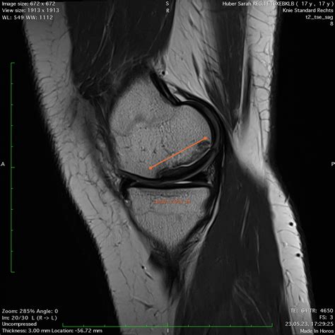 Osteochondritis Dissecans Orthopedist Vienna