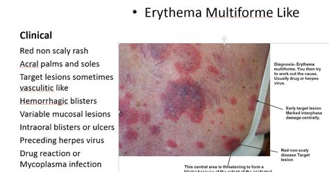 Dermatopathology Made Simple Inflammatory Interface Vacuolar Reaction Pattern