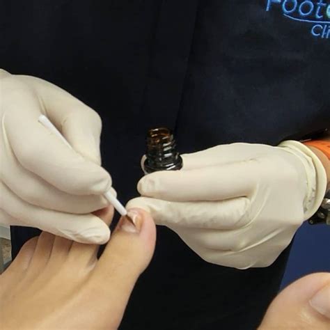 Keryflex Nail Restoration The Footcare Clinic