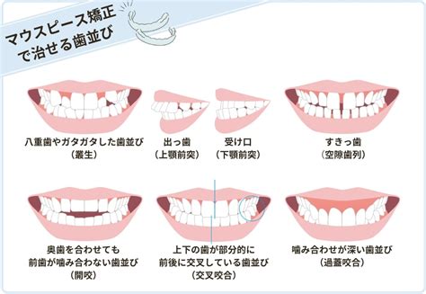 マウスピース矯正で八重歯の矯正は可能？費用や期間・症例写真も紹介 【公式】キレイライン矯正｜実績12万人｜最短25ヶ月のマウスピース矯正