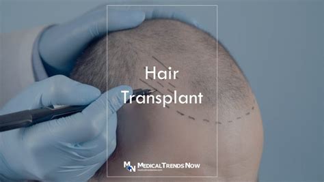 Hair Transplant In The Philippines A New Hope For Balding Filipinos
