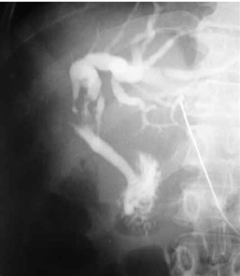 Ptc In A Patient Who Failed Ercp Cannulation Of The Biliary System Download Scientific Diagram