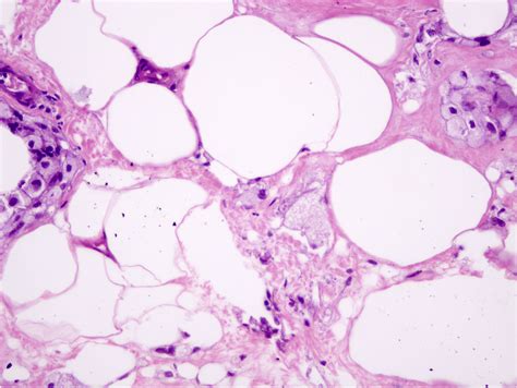 Early Stage Lipodermatosclerosis Centrilobular Necrosis And Ghost