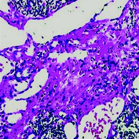 A Giant Lymphangioma In The Left Postauricular Area Download