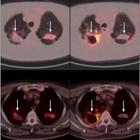A 70 Year Old Man With History Of Colon Cancer Old Tuberculosis Download Scientific Diagram
