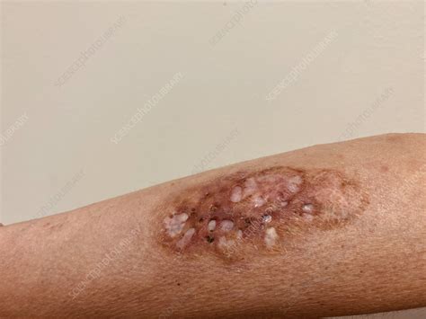 Pyoderma Gangrenosum After Diverticulitis Surgery Stock Image C056 0536 Science Photo Library