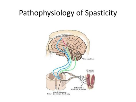 Ppt Spasticity Management In Neurological Conditions Powerpoint