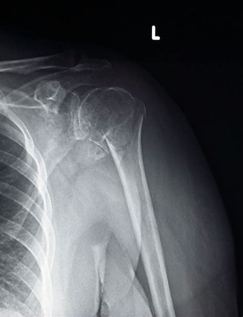 Left Humerus Fracture Surgical Neck Of The Humerus Wikipedia