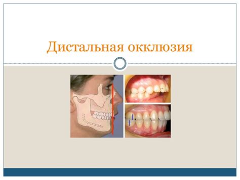 Дистальная окклюзия презентация онлайн