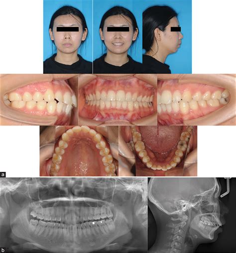 Preformed Intrusion Bulbs On Clear Aligners Facilitate Active Vertical Control In A