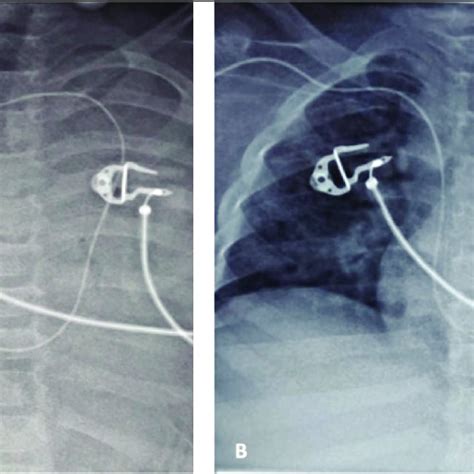A Ap View Of Cxr Showing A Picc Line Coursing Down The Left