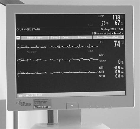 1 Monitor Displays Three Leads And St Segment Monitoring Download Scientific Diagram