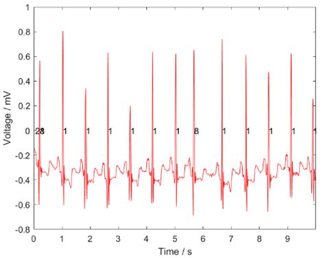 Arma模型谱估计matlab基于机器学习的心律失常分类四——心电信号特征提取 Matlab Csdn博客 Arma模型谱估计matlab基于机器学习的心律失常分类四——心电信号特征提取 Matlab Csdn博客
