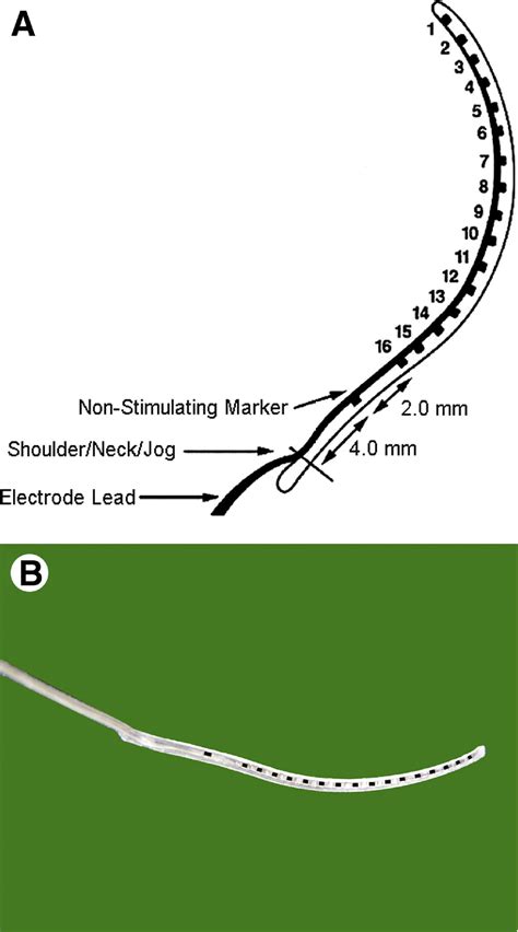 Cochlear Implant Electrode Insertion Operative Techniques In Otolaryngology Head And Neck Surgery