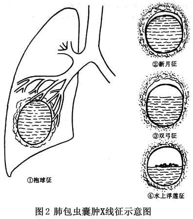 肺结构图画画 肺结核儿童画 画出一个简笔画的肺 大山谷图库